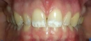 "Macchie sui denti | cosa le causa e cosa fare" - Centro Odontoiatrico Roma